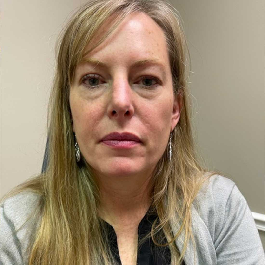 Lower Eyelid Blepharoplasty Gallery – OPSGA