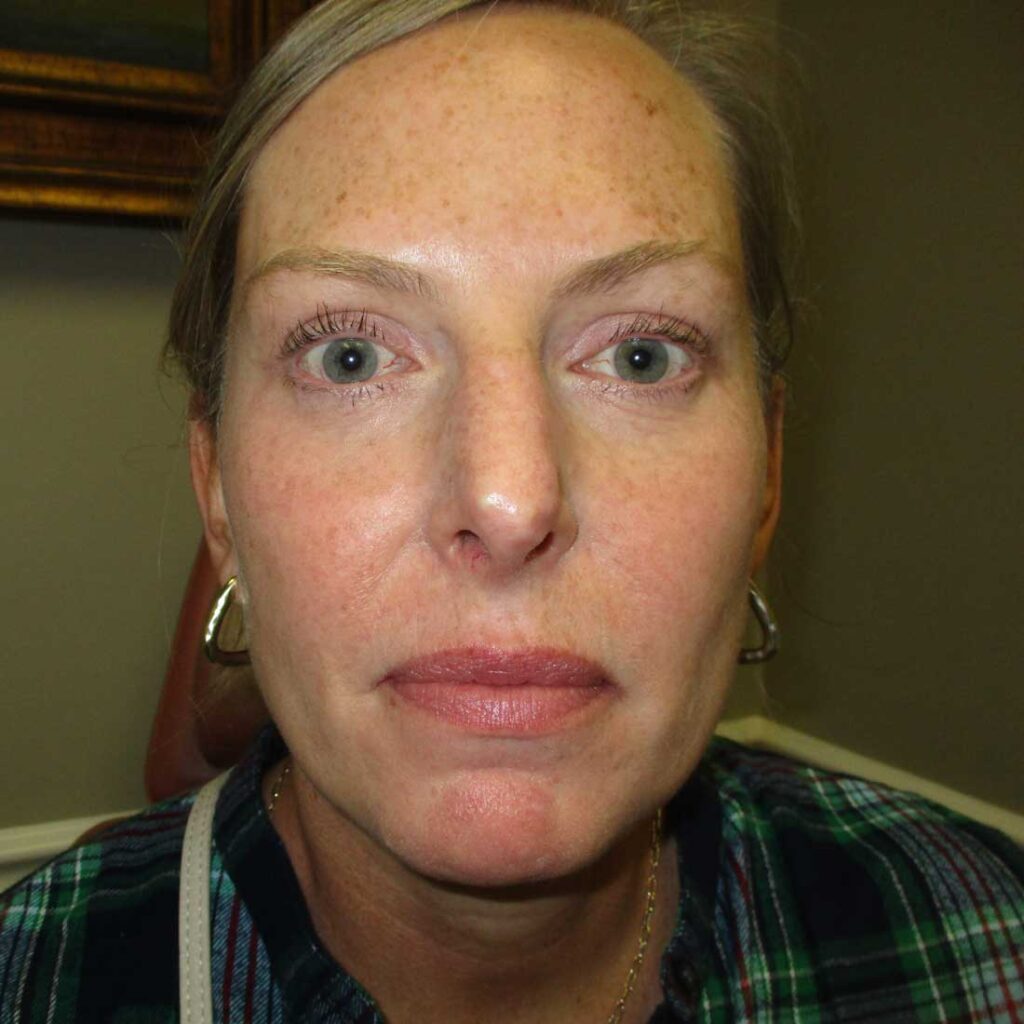 Lower Eyelid Blepharoplasty Gallery – OPSGA